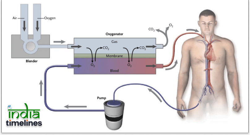 Understanding ECMO Program: Lifesaving Technology Explained